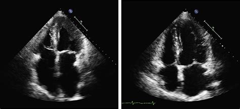 Echocardiogram Normal And Abnormal Findings