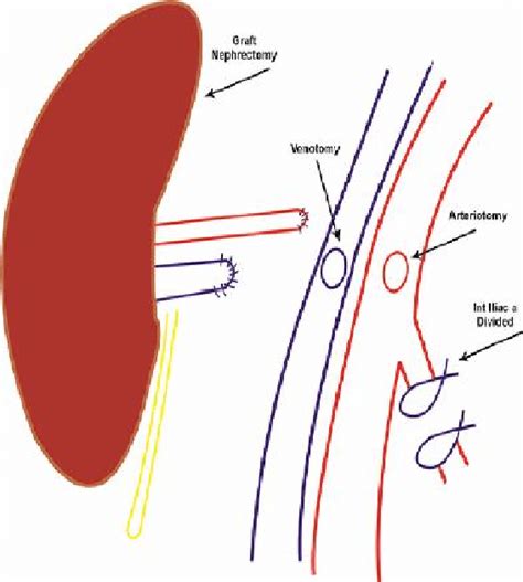 The Fourth Operation Allograft Nephrectomy And Ligation And