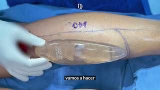 Cirugía De Implantes De Pantorrillas I Dr David Delgado Doovi