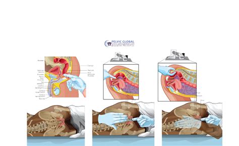 Coccyx Rectum Rectal And Prostate Palpation Sidelying Prone Supine