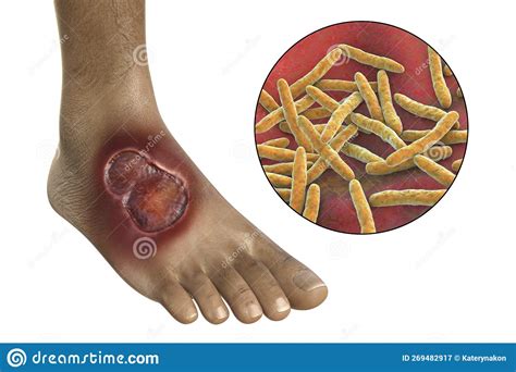 Buruli Ulcer On A Patient Foot 3d Illustration The Disease Caused By Mycobacterium Ulcerans