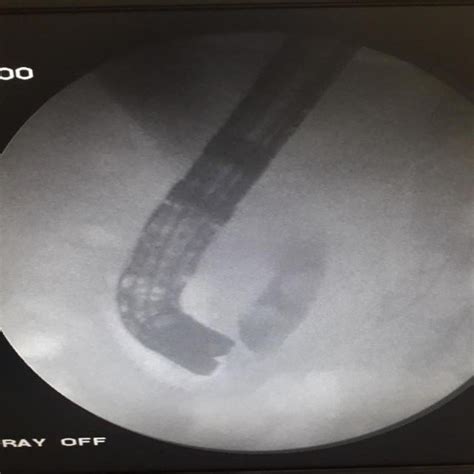 Showing Filling Defect In Cholangiogram No Filling Defect In Check Download Scientific Diagram