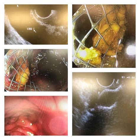 Daniel Eli” Penn Md Fasge On Linkedin Endoscopic Choledocho