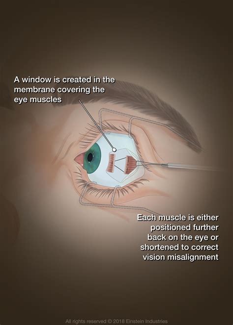 Eyes Crossed After Strabismus Surgery At Justin Bee Blog