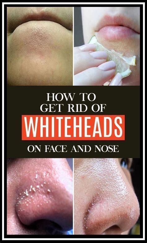 Whiteheads On Nose White Head Remedies How To Get Rid Of White Heads