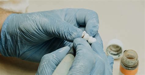 Nasal Rim And Nasal Spine Dental Implants Dental Implants Kelowna