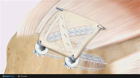 Dermal Allograft For Rotator Cuff Augmentation Orthopedia