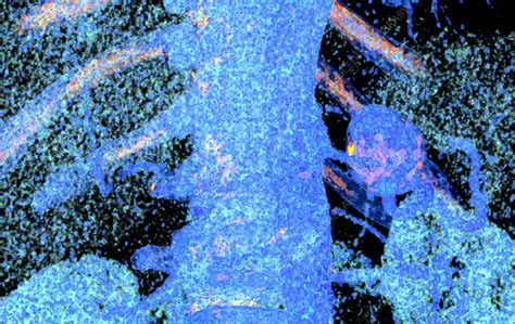 Splenic Artery Aneurysm Ct Scan Stock Image C0582803 Science