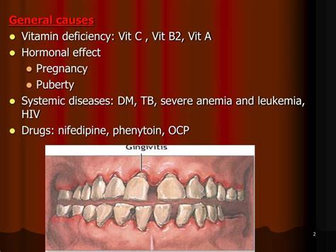 Ppt Gingivitis Inflammation Of Gingival Tissues Commonly Associated