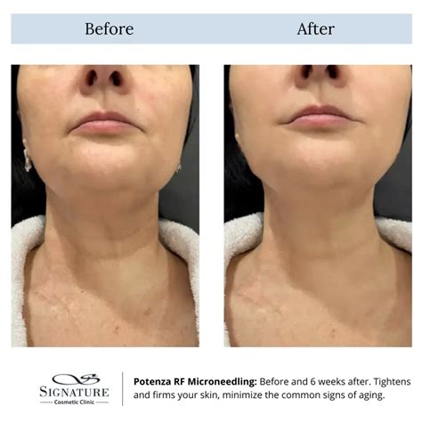 Potenza Rf Microneedling Toronto Potenza Treatment Signature