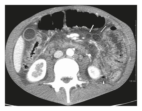 Ct Abdomenpelvis With Iv Contrast Axial White Arrows Mesenteric