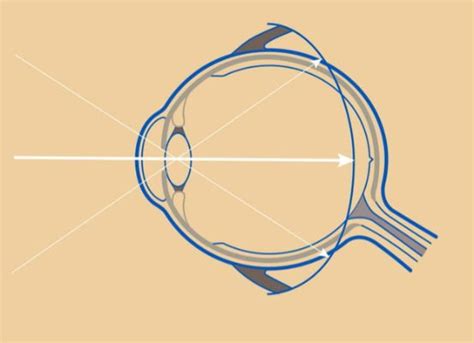 Myopia Control Darling St Optometrix