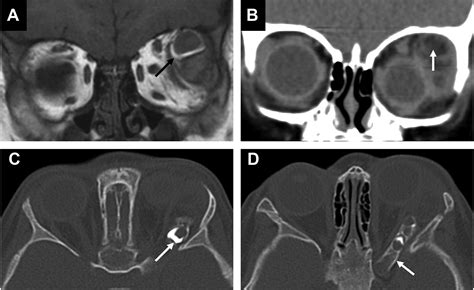 Extraocular Orbital And Peri Orbital Masses Neuroimaging Clinics