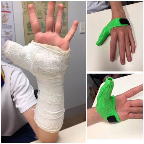 Best Splint Material Materials Used In Splint Making A Comprehensive