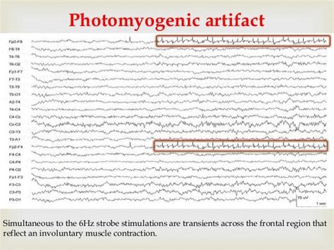 Eeg Artifacts
