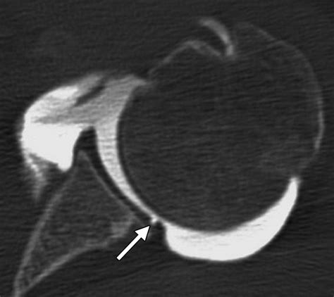 Shoulder Arthrogram Acl Technology And Techniques In Radiology