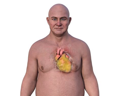 Man With Obese Heart With Visible Fat Deposits Around It 3d