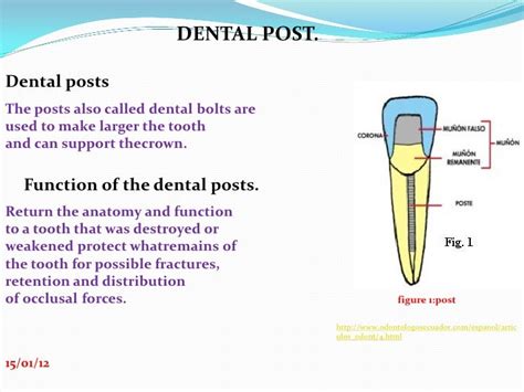Dental Post