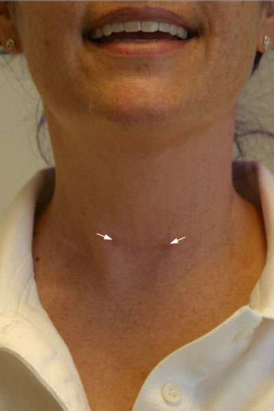 Thyroidectomy Scar Photos Thyroid Cancer Surgery Scars Endocrine