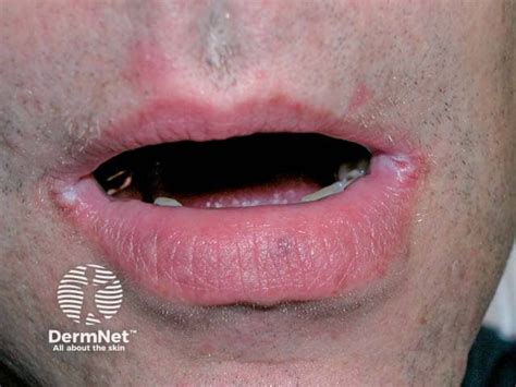 Causes Of Angular Cheilitis Pictures Photos