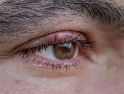 Difference Between Blepharitis And Preseptal Cellulitis Difference Between Blepharitis Vs