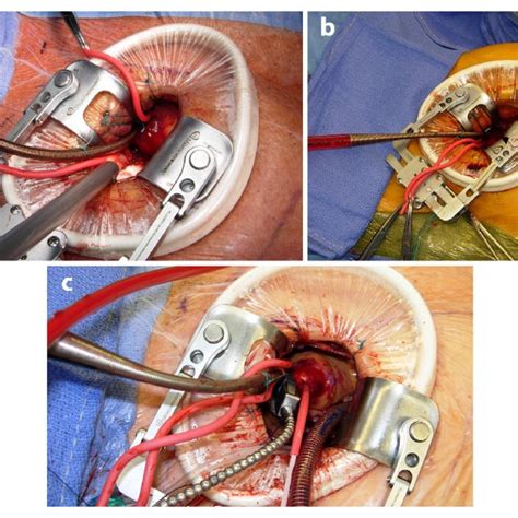 Central Aortic Cannulation A The Aorta Is Directly Cannulated