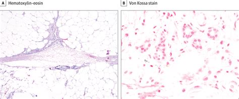 Warfarin Associated Nonuremic Calciphylaxis Anticoagulation Jama Dermatology Jama Network