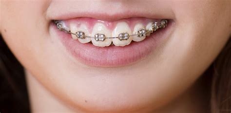 Class 2 Skeletal Malocclusion Dr Haroon Dental Specialist Clinic