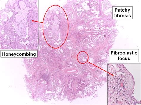 Idiopathic Pulmonary Fibrosis Histology