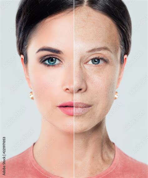 Woman Lips Before And After Lip Filler Injectionsaging And Youth Concept Stock Photo Adobe Stock