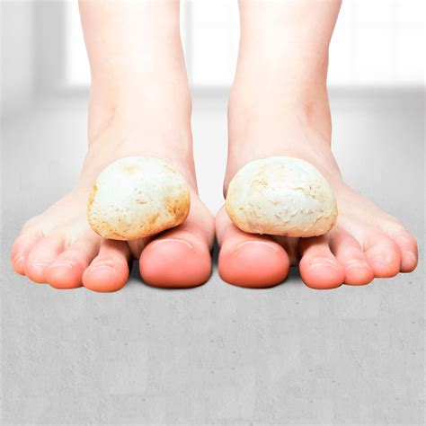 Tratamiento De Hongos En La Piel Pie De Atleta Y Dermatomicósis