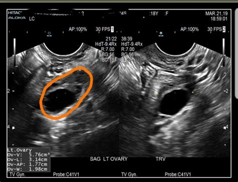 Functional Ovarian Cyst Ultrasound