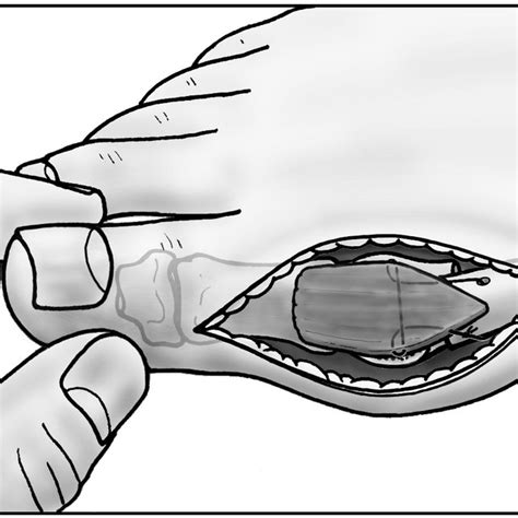 Osteotomy Secured And Covered Download Scientific Diagram