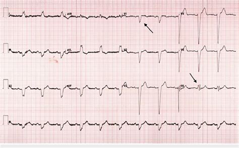 Ekg Showing Left Axis Deviation And Left Bundle Branch Block Qrs