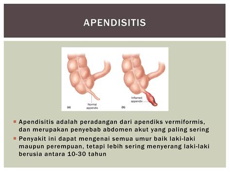 Usus Buntuppt