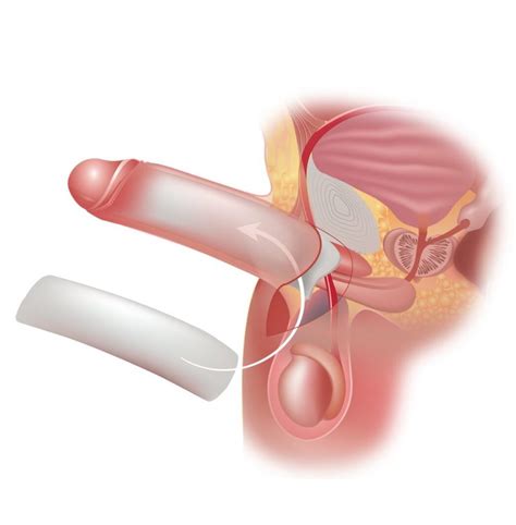 Unbelievable Penuma Implant For Penis Enlargement Surgery 2024