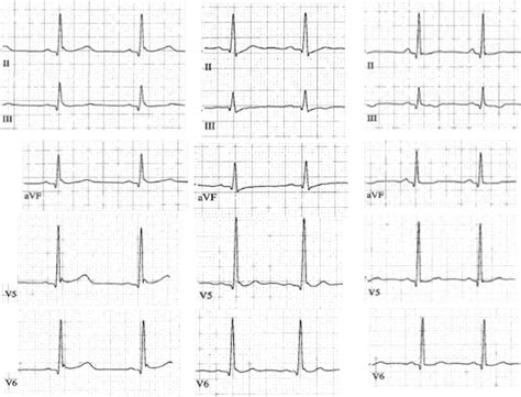 A Clinical Approach To Early Repolarization Circulation