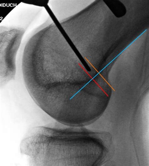 Intraoperative Localization Of The Schottle Point The Blue Line Is Drawn Down The Posterior