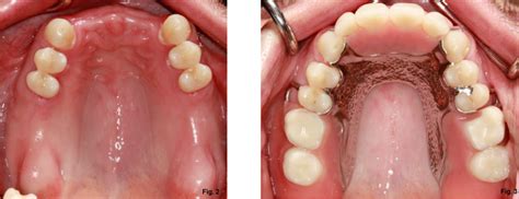 Classification Of Removable Partial Denture Design Talk