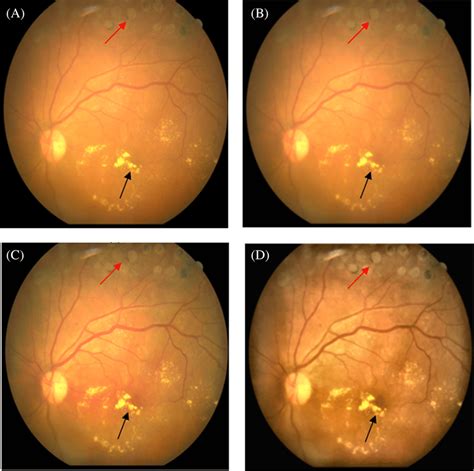 Median Het Noscu Enhancement Algorithm On Low Contrast Bright Fundus