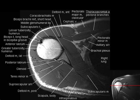 Mri Anatomy Of Shoulder At Leonard Kaminski Blog