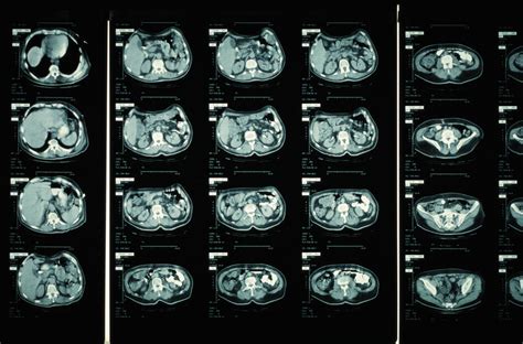 Ct Scan Computerized Tomography Cat Scan Or Ct Semmes Murphey