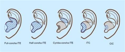 Types Of Earmolds For Hearing Aid Skeleton Custom