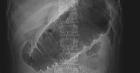 10 Signs Of Toxic Megacolon