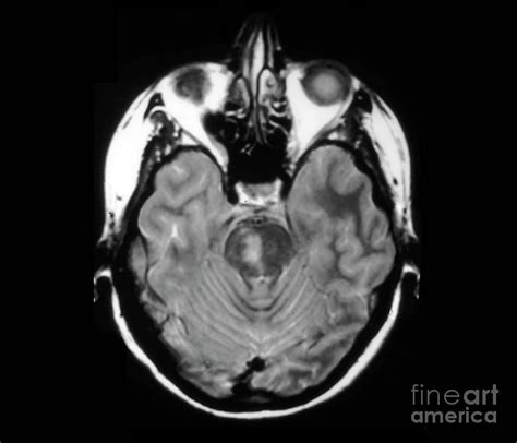 Brainstem Stroke Photograph By Science Photo Library Pixels Merch