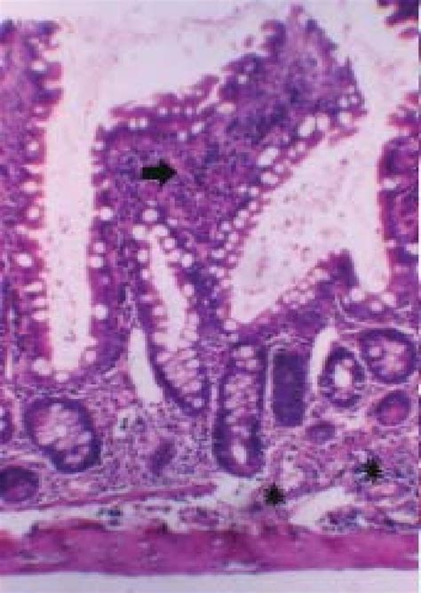 A Showing Mononuclear Cellular Infiltration Thick Arrow And Dilated