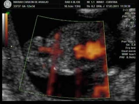 Descobrindo o sexo do bebê com 12 semanas e 4 dias YouTube