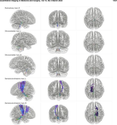 Figure 2 From The Language Related Cerebro Cerebellar Pathway In Humans A Diffusion Imaging