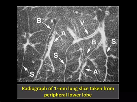 Figure 3 Sign Fleischner Sign Fissure Sign Headcheese Sign Hilar