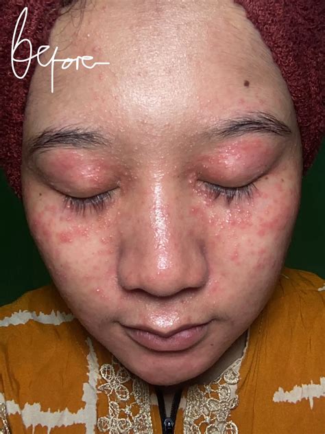 Dermatitis Perioral Galeri Diposting Oleh Devidry Lemon8